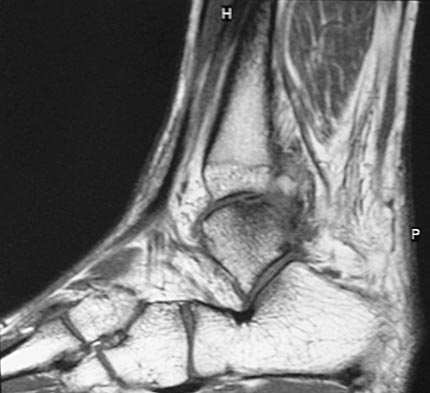Osteochondral Lesions of the Talus - Foot & Ankle - Orthobullets